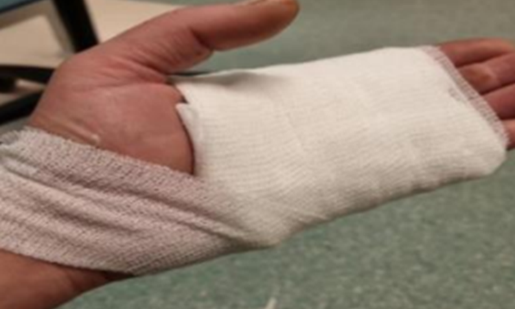 Snij-incident door het uitschieten van het mes